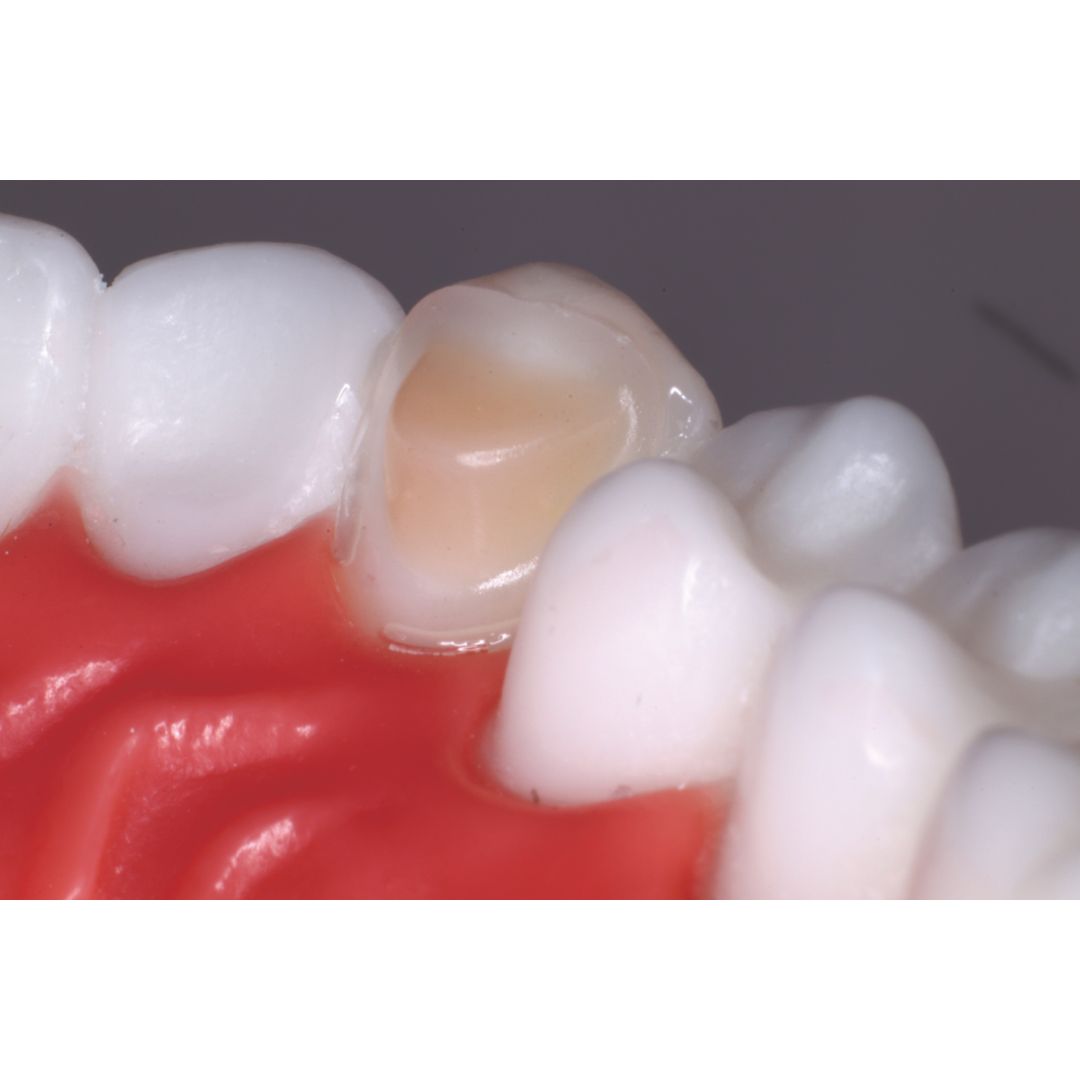FBE435 : Reliamold Cuspid Attachment