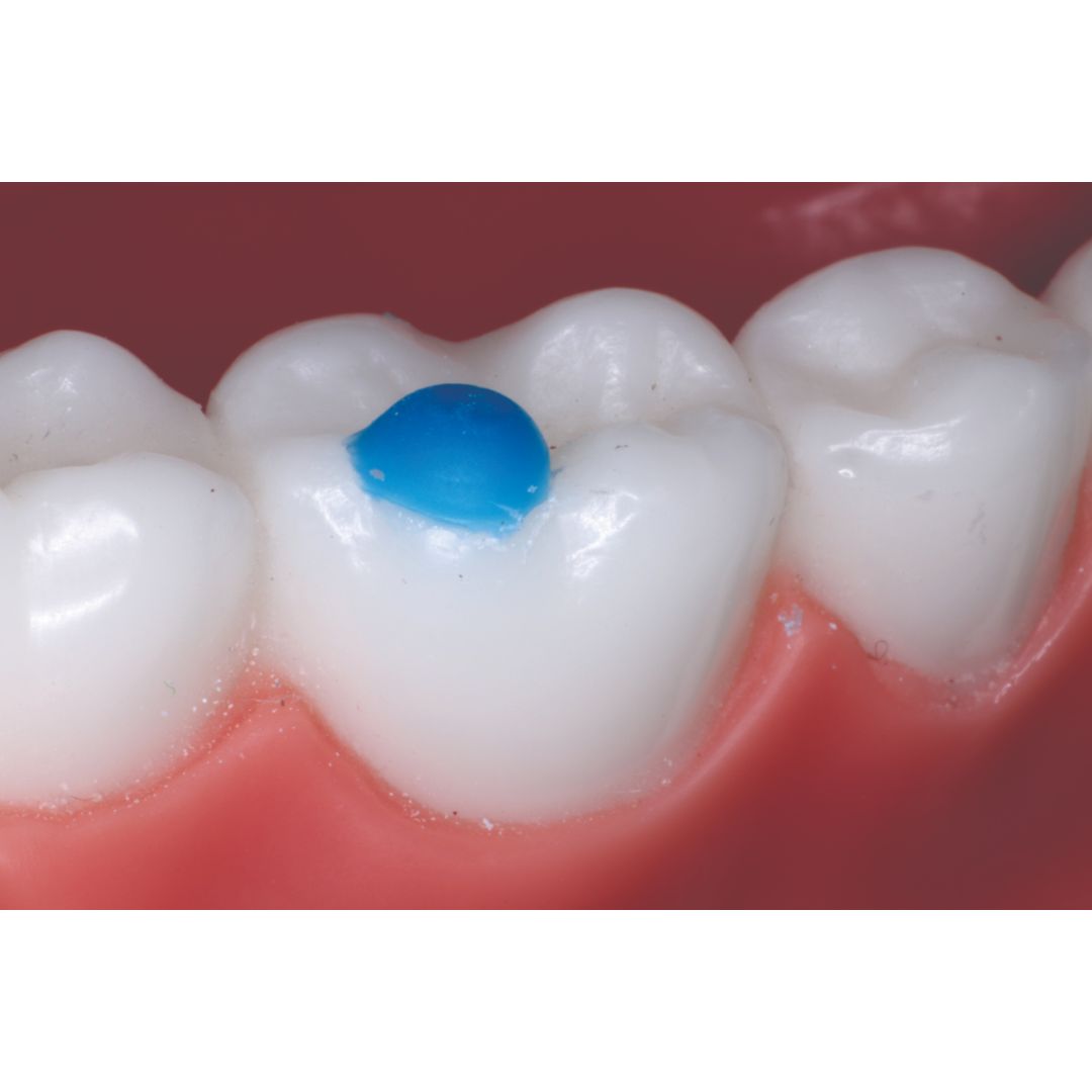 FBE438 : Reliamold Molar Pad Attachment