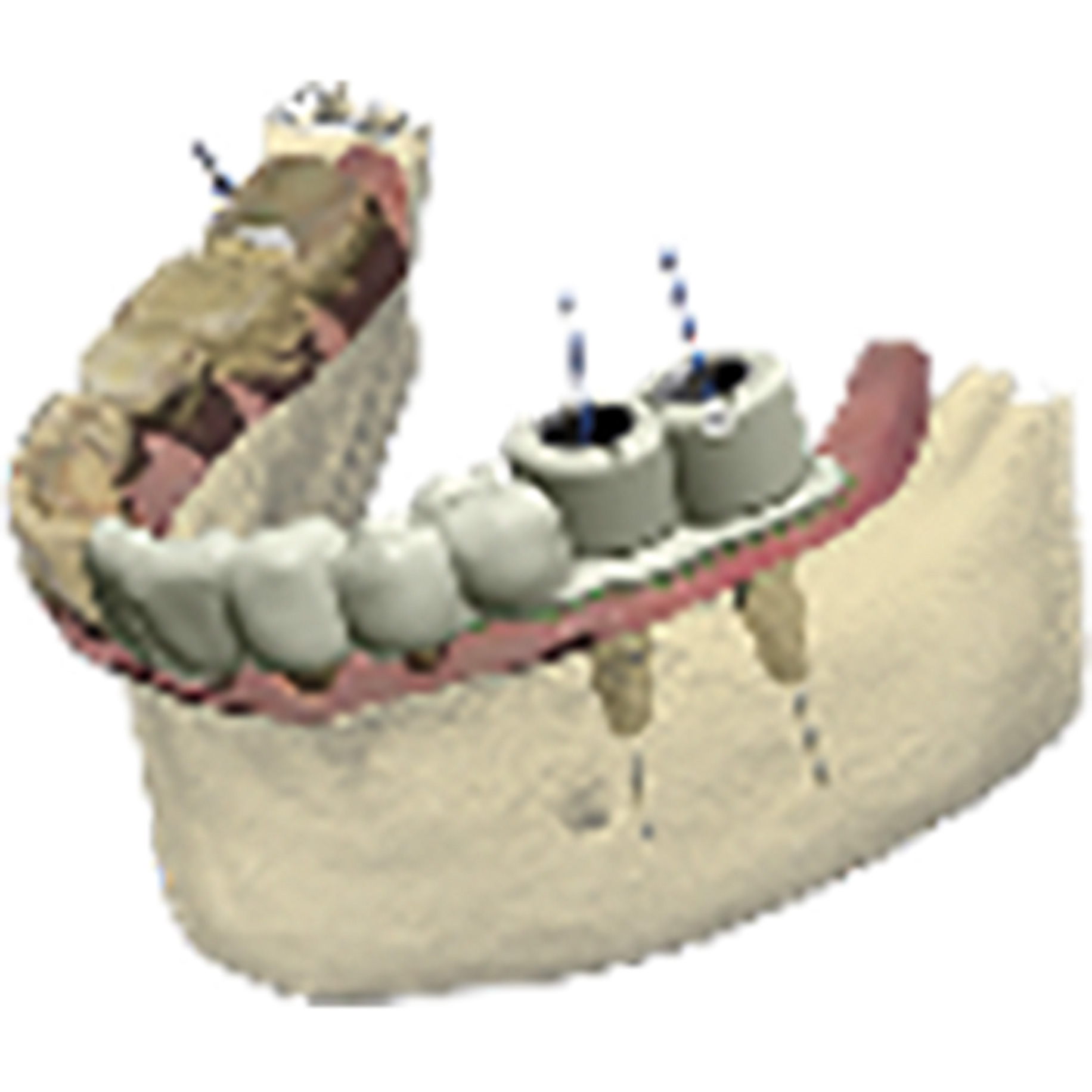 QWT550 : 3Shape Implant Studio Full Solution Stand Alone